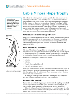 Labiaplasty and Labia Minora Reduction