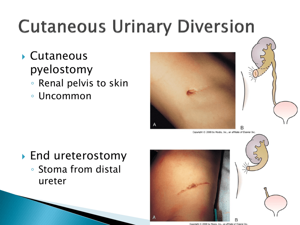 Urostomy Status Icd 10 Urostomy Status Icd 10